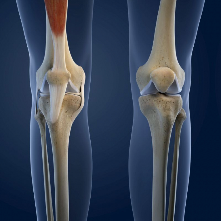 Beschwerdebilder der Kniescheibe: Die Patelladysplasie - Fuß-Schule ...